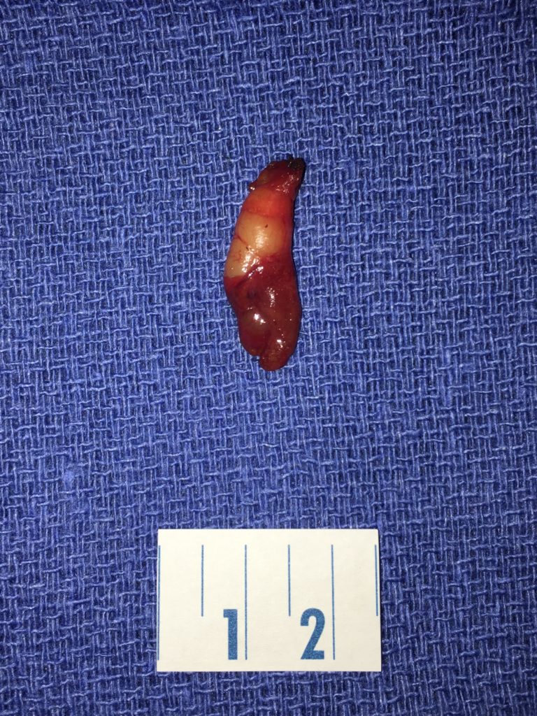 Parathyroid Pathology - Atlanta's Advanced Thyroid and Parathyroid Center